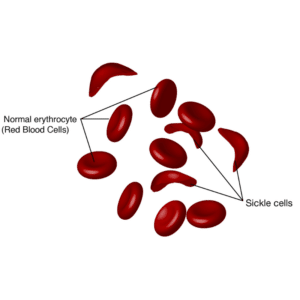 Sickle Cell Disease - ClearIAS